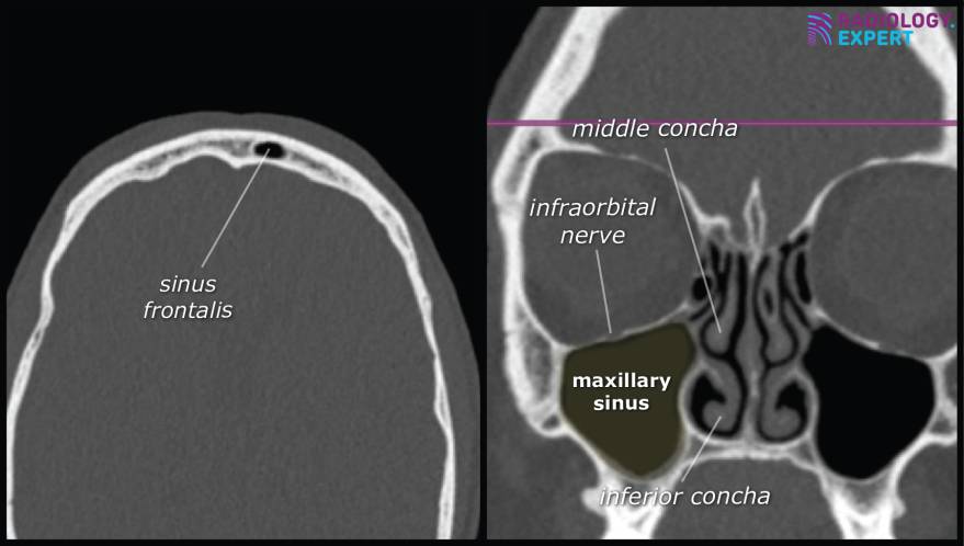CT sinus