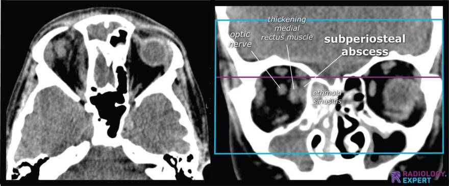 CT sinus