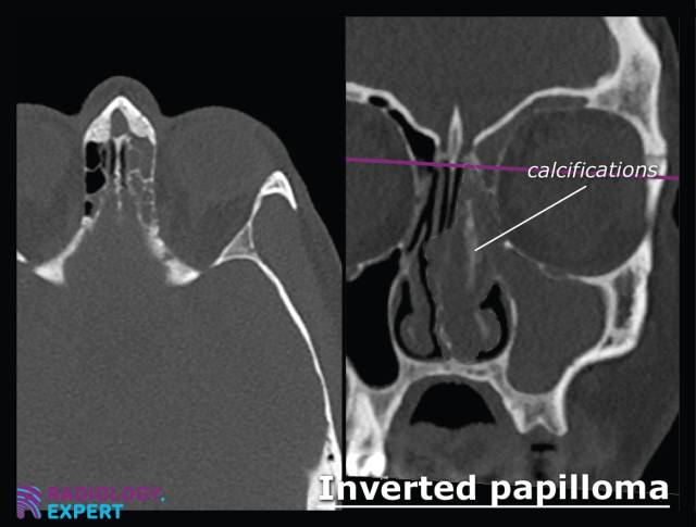 CT sinus