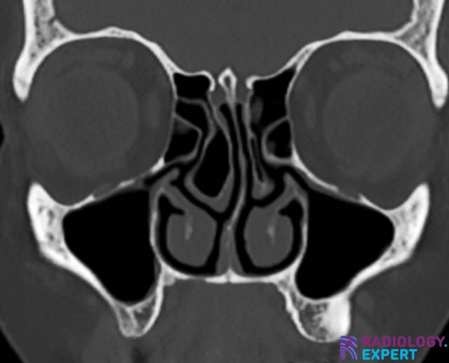 CT sinus