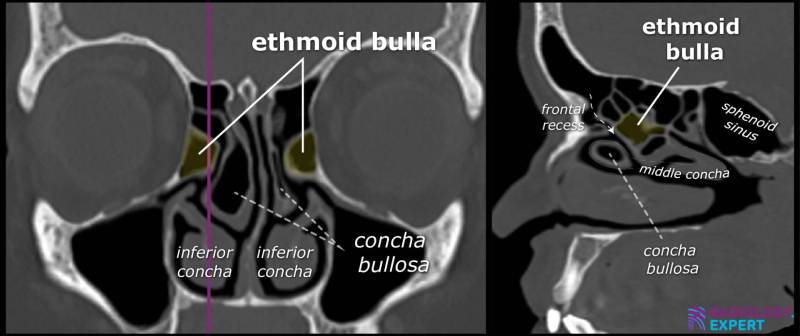 CT sinus