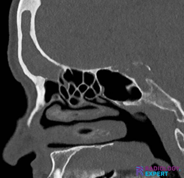 CT sinus