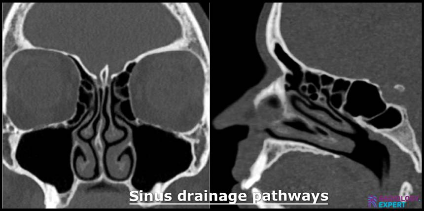 CT sinus