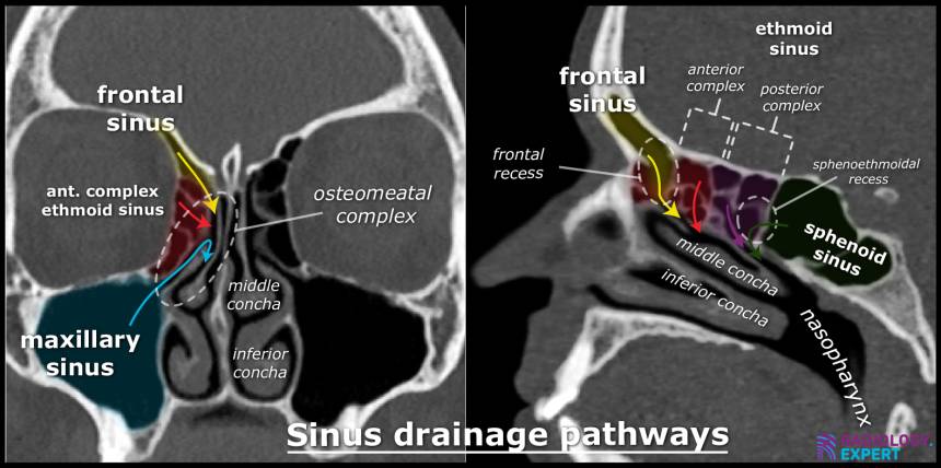 CT sinus