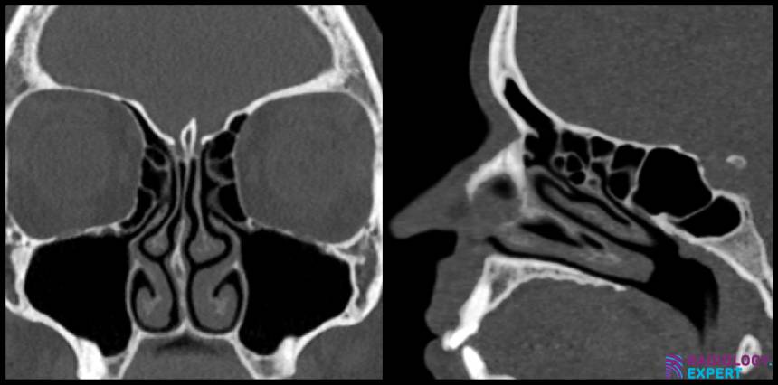 CT sinus