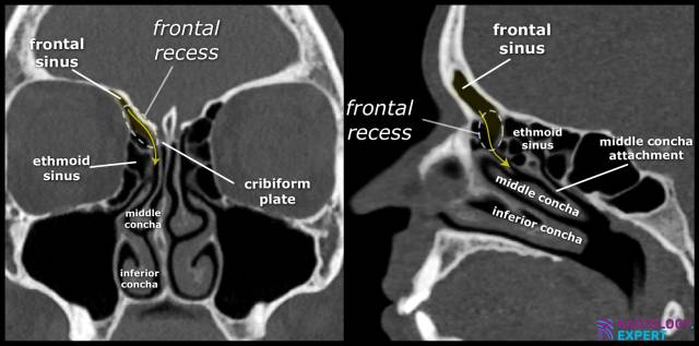 ethmoidal infundibulum ct
