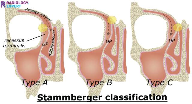 uncinate process sinus
