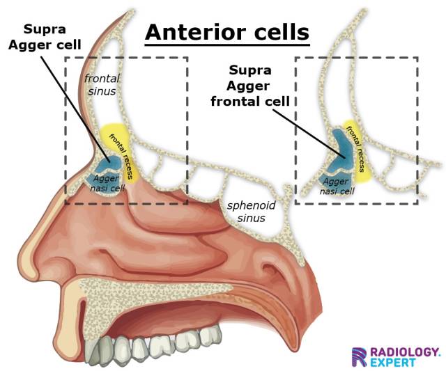 CT sinus