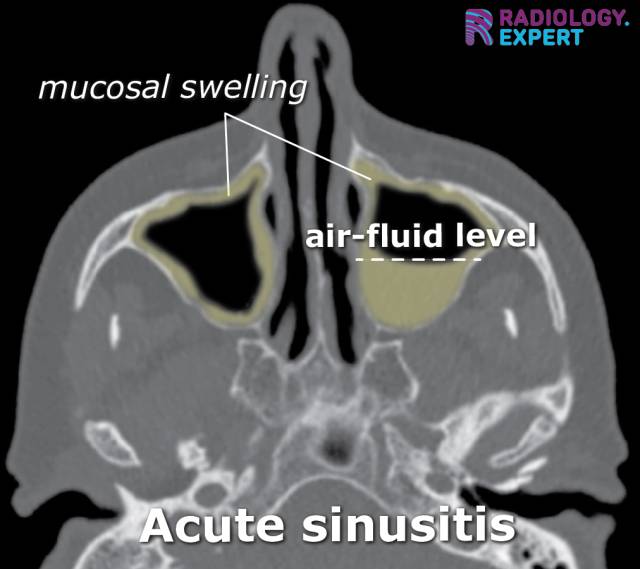 CT sinus