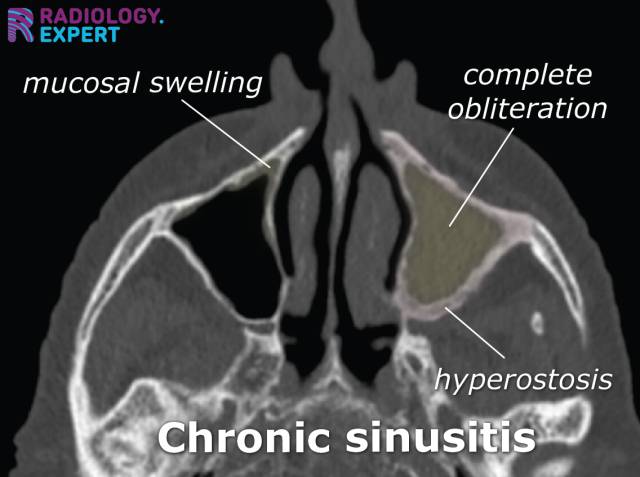 CT sinus