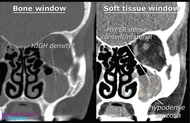 maxillary sinus bone ct