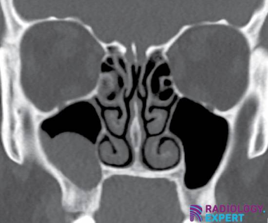 CT sinus
