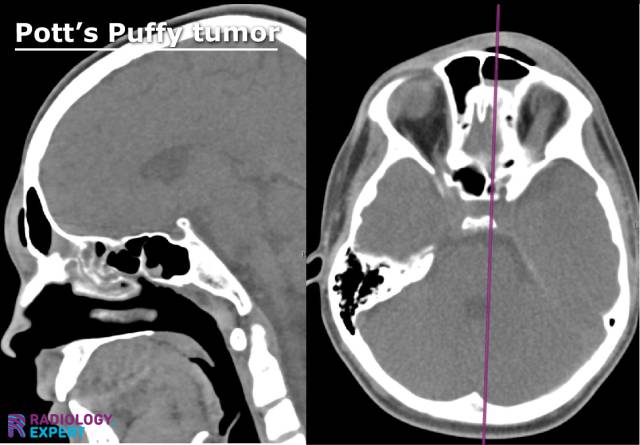 CT sinus