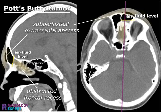 CT sinus