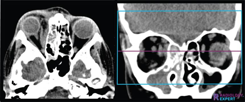 CT sinus