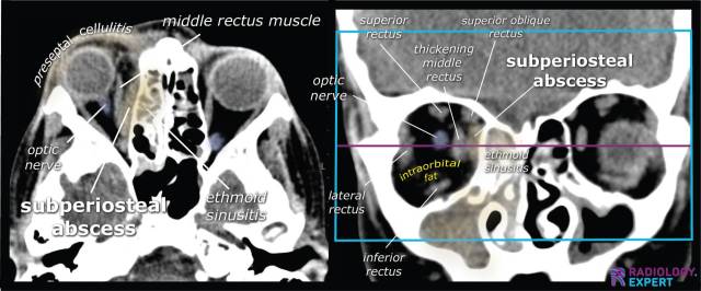ethmoidal sinusitis ct