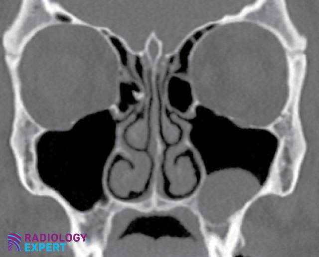 CT sinus