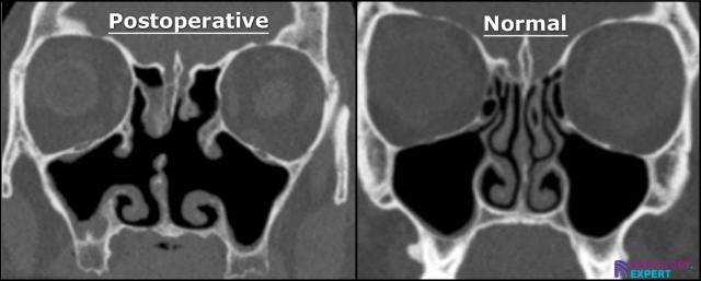 atrophic rhinitis ct