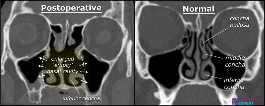 CT sinus