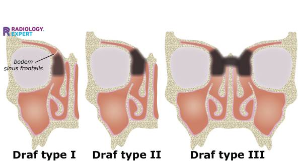CT sinus