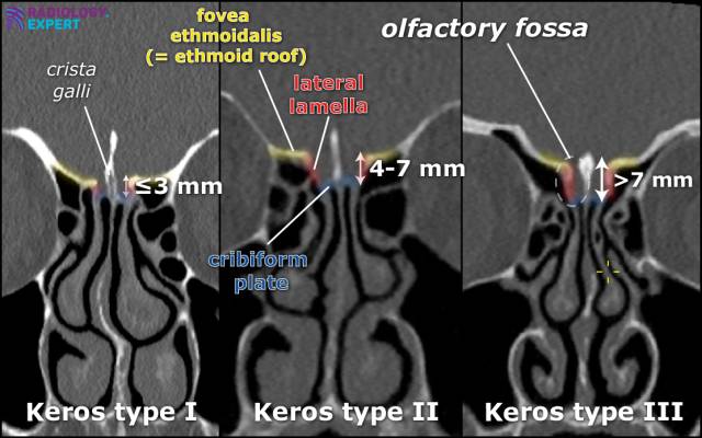middle clinoid process ct