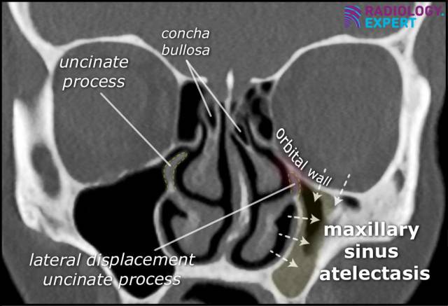 uncinate process sinus