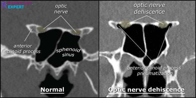 ethmoid sinus ct