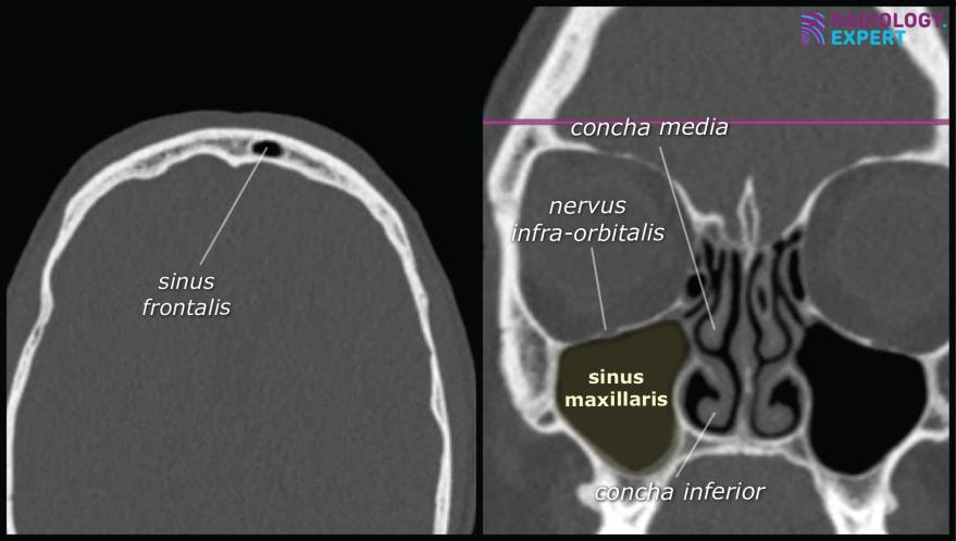 CT sinus