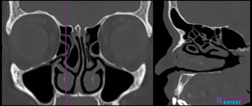CT sinus