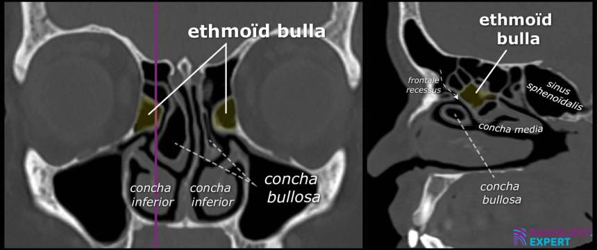 CT sinus