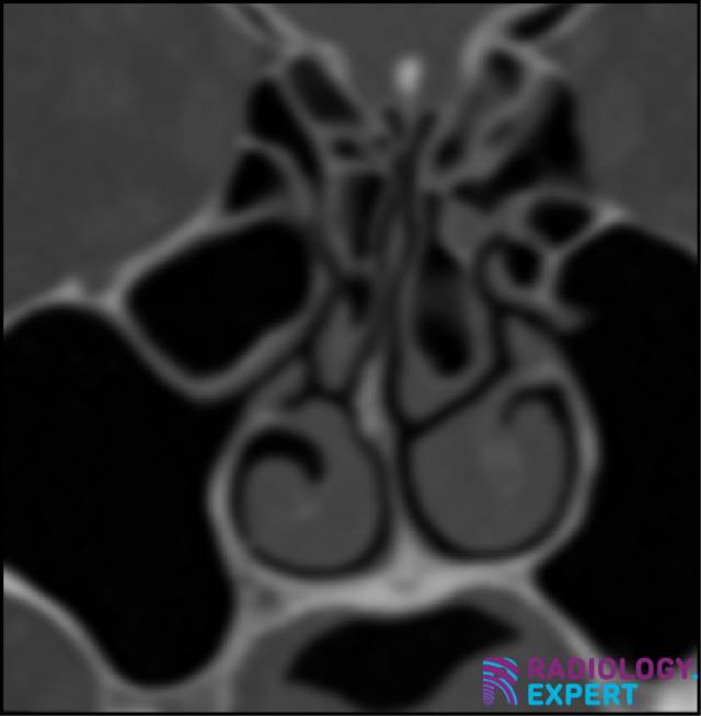 CT sinus