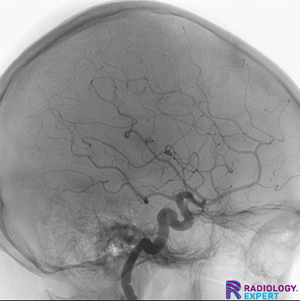 Interventional Radiology - The Stroke Patient