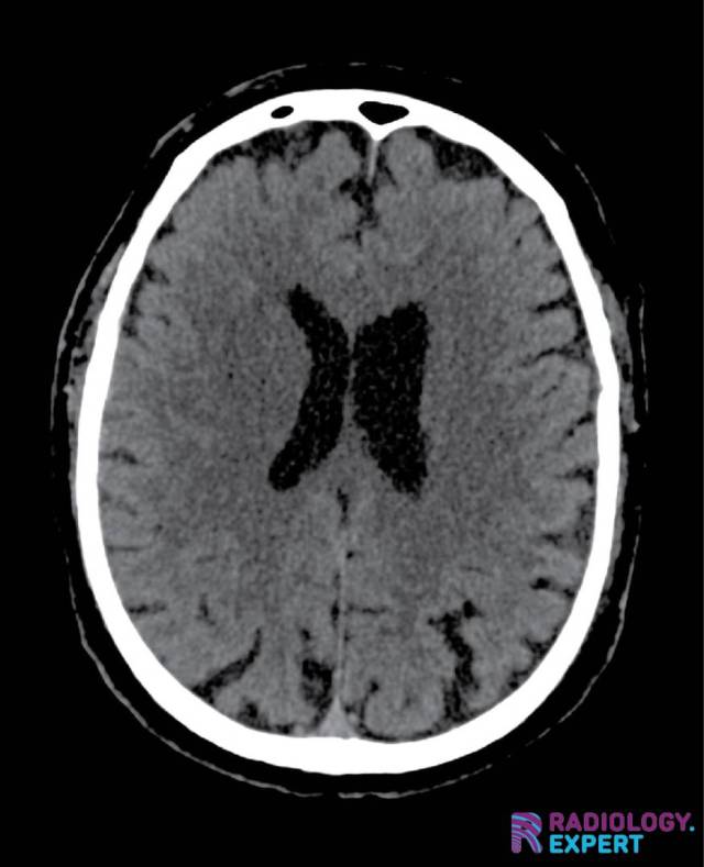 Interventional Radiology - The Stroke Patient
