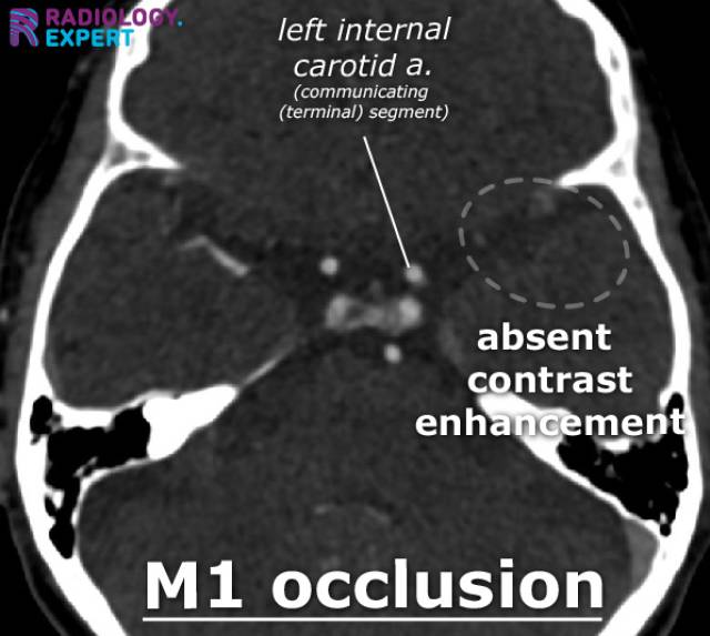 Interventional Radiology - The Stroke Patient