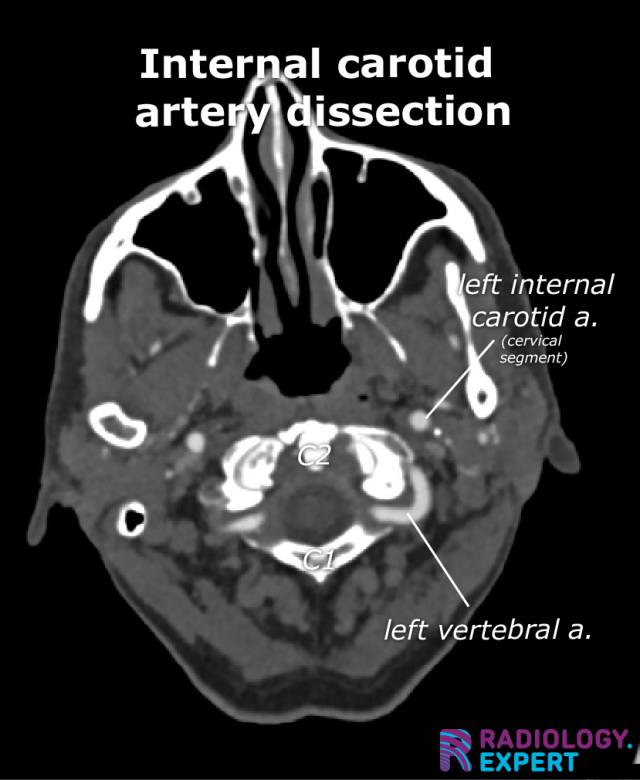 Interventional Radiology - The Stroke Patient