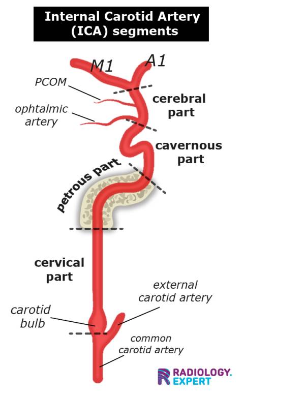 Interventional Radiology - The Stroke Patient