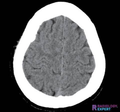 Interventional Radiology - The Stroke Patient