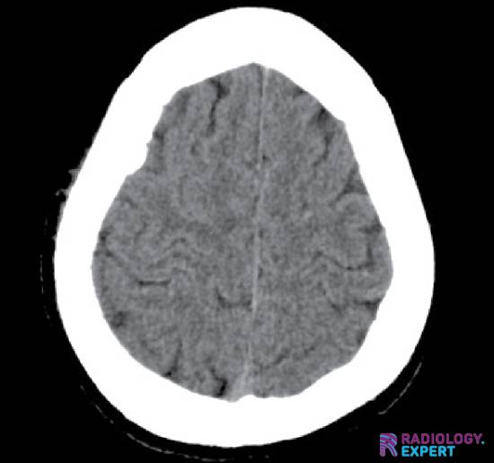 Interventional Radiology - The Stroke Patient
