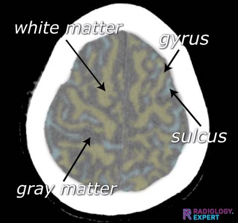 Interventional Radiology - The Stroke Patient