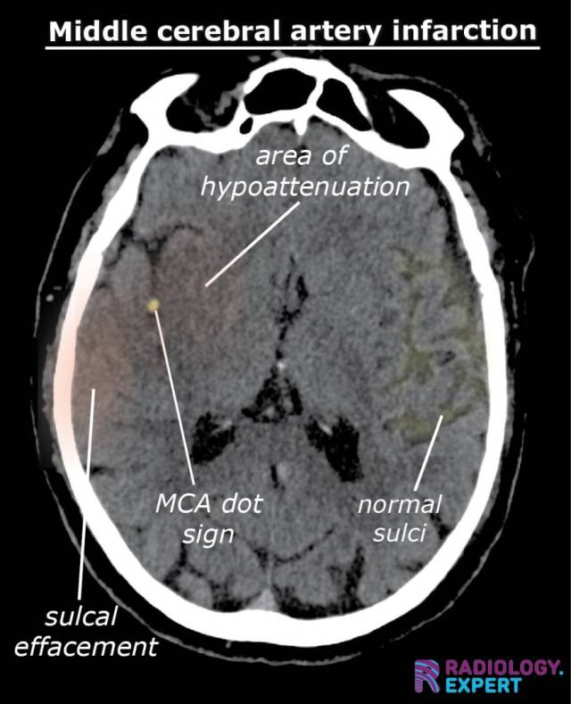 Interventional Radiology - The Stroke Patient