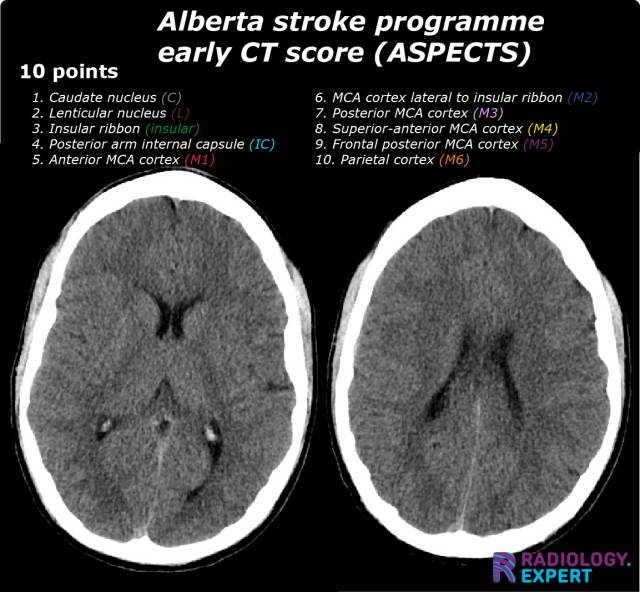 Interventional Radiology - The Stroke Patient