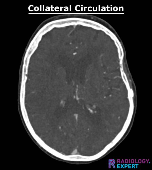 Interventional Radiology - The Stroke Patient