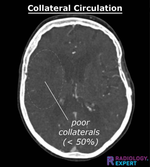 Interventional Radiology - The Stroke Patient