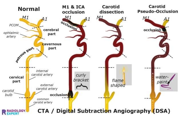 Interventional Radiology - The Stroke Patient