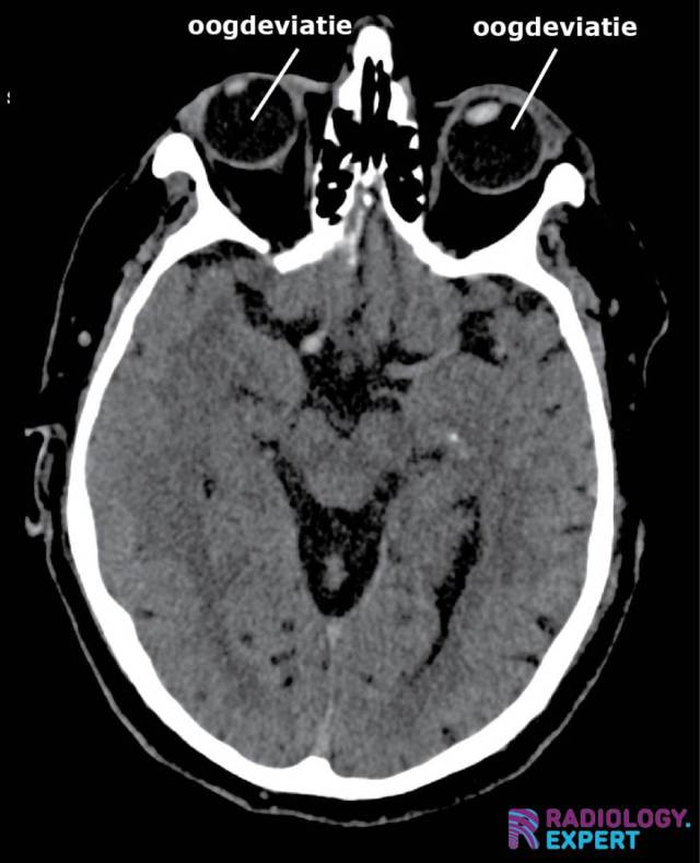 Interventieradiologie - De CVA Patient