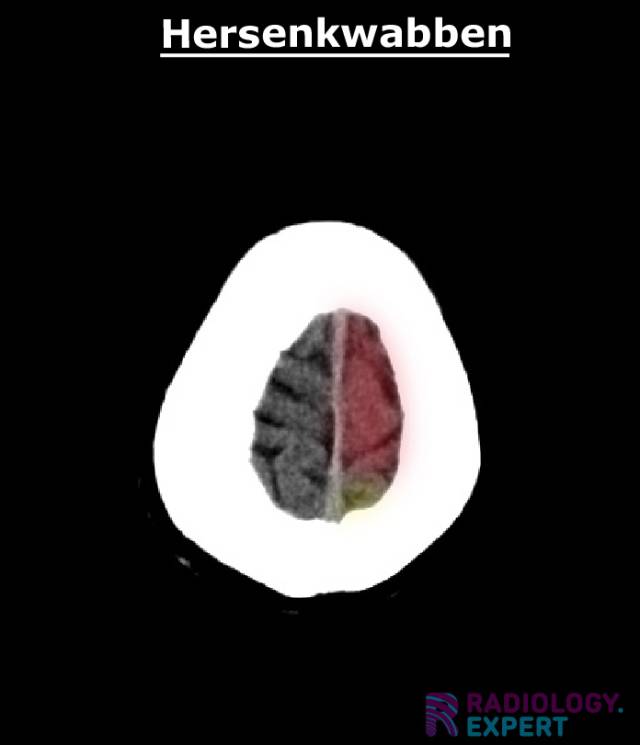 Interventieradiologie - De CVA Patient