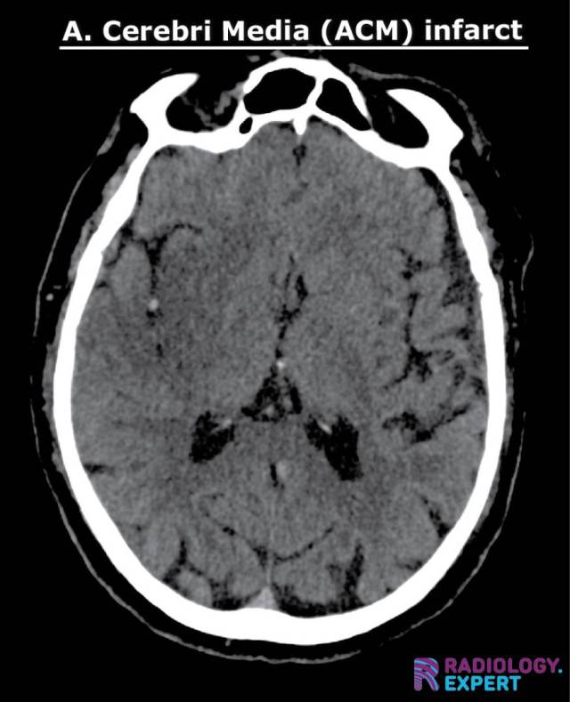 Interventieradiologie - De CVA Patient