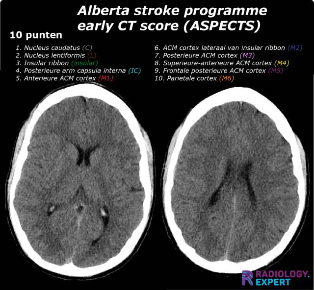 Interventieradiologie - De CVA Patient