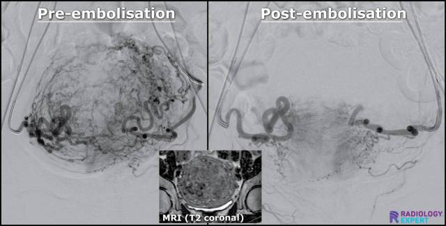 Interventional Radiology - Non-Oncological