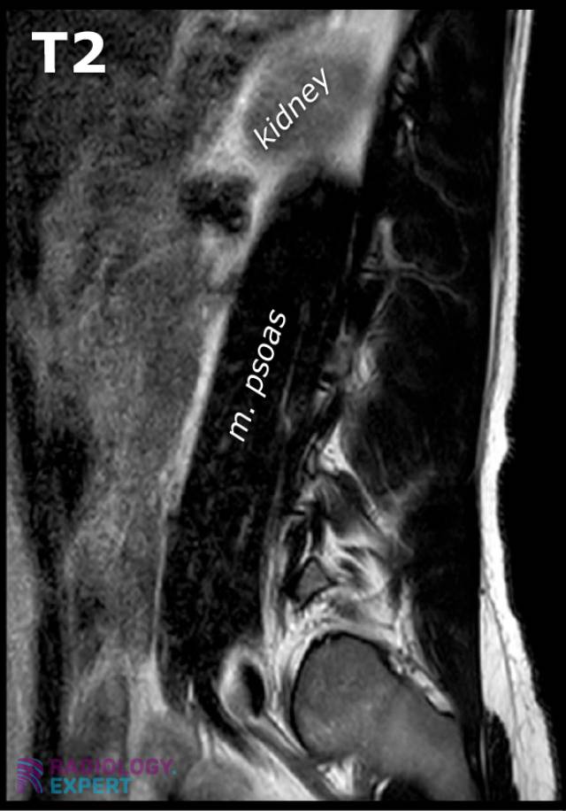MRI Lumbar Spine